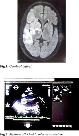 Stroke Due to Left Atrial Myxoma